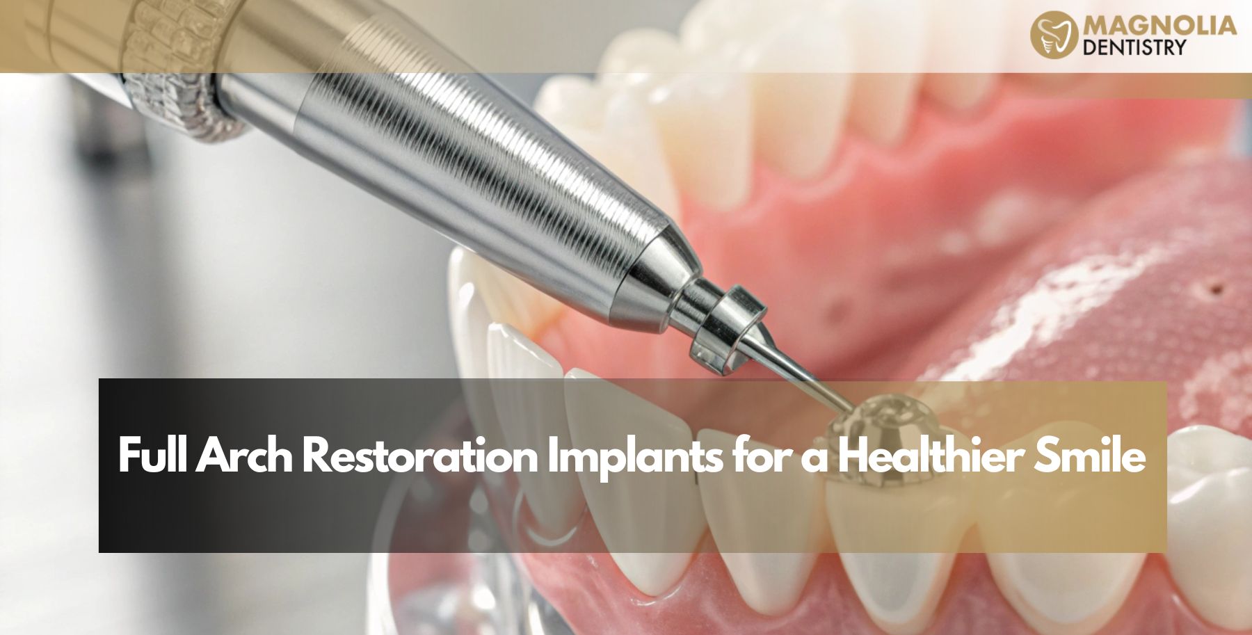 Full Arch Restoration Implants for a Healthier Smile | Magnolia Dentistry