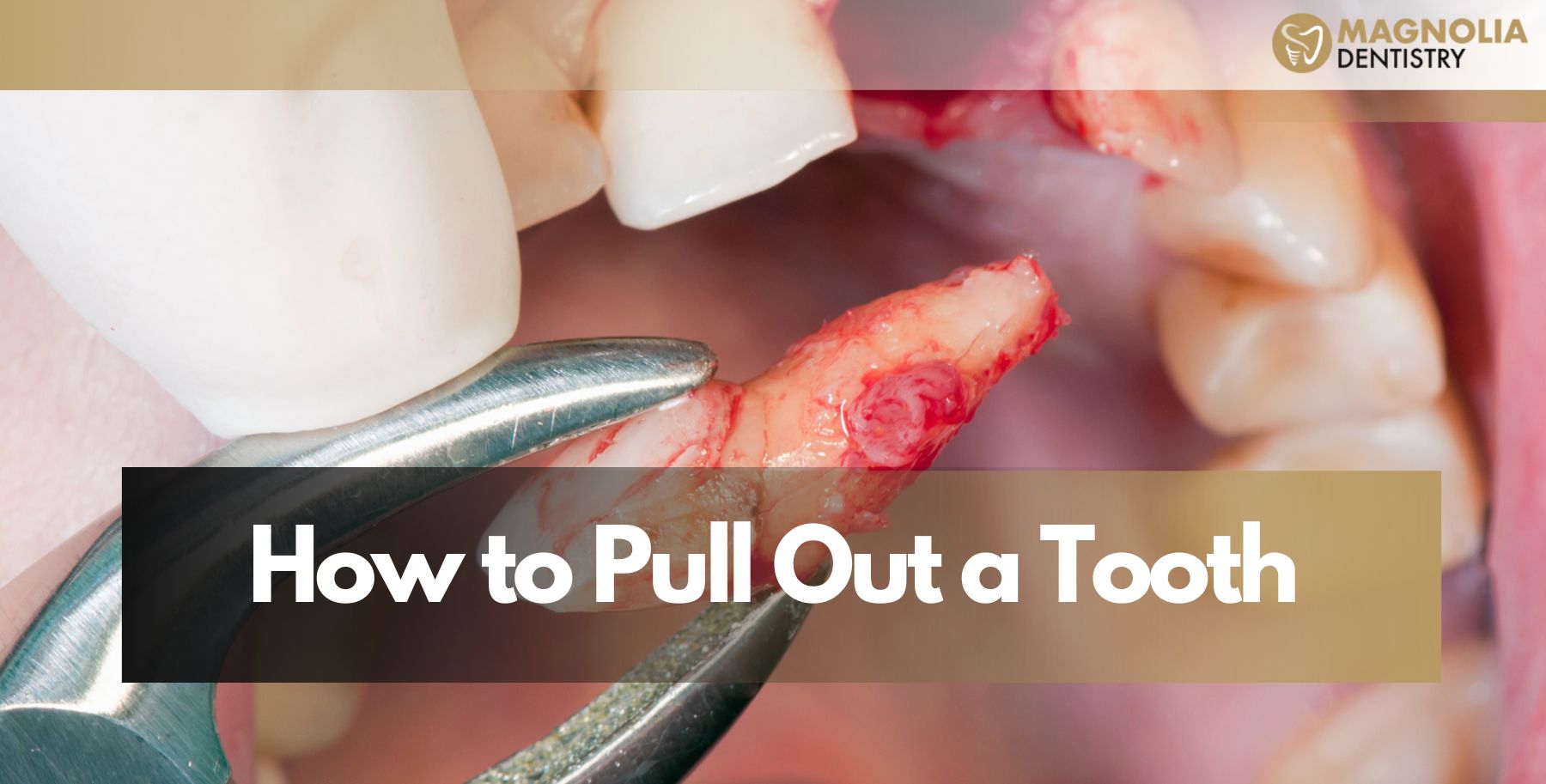 How to Pull Out a Tooth | Magnolia Dentistry