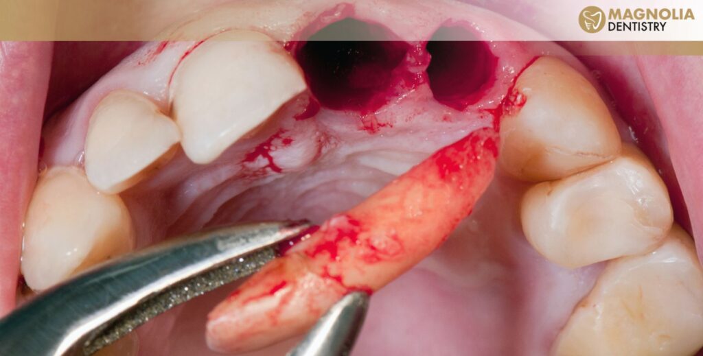 What Are the Side Effects of a Tooth Extraction | Magnolia Dentistry