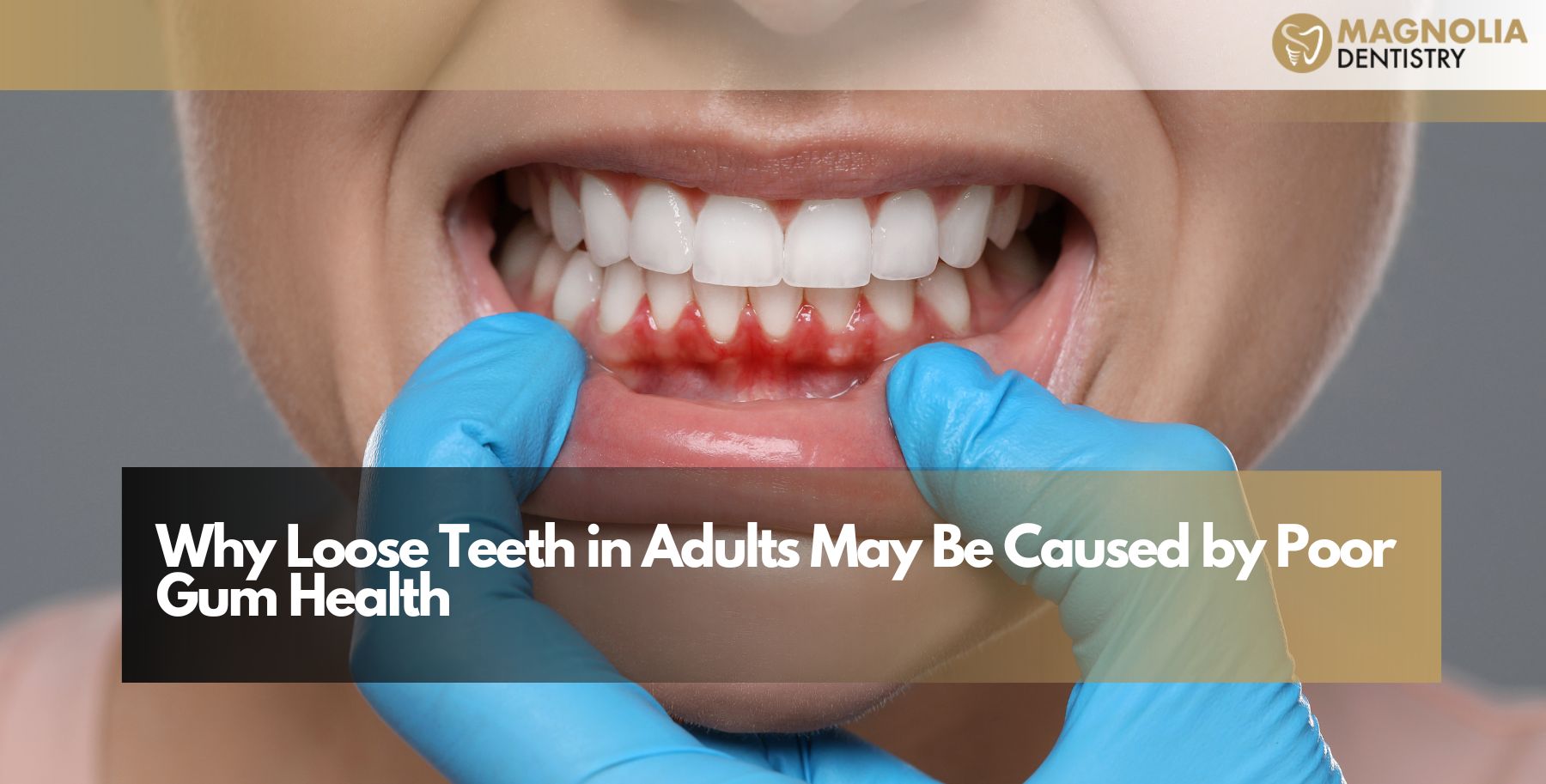 Why Loose Teeth in Adults May Be Caused by Poor Gum Health | Magnolia ...
