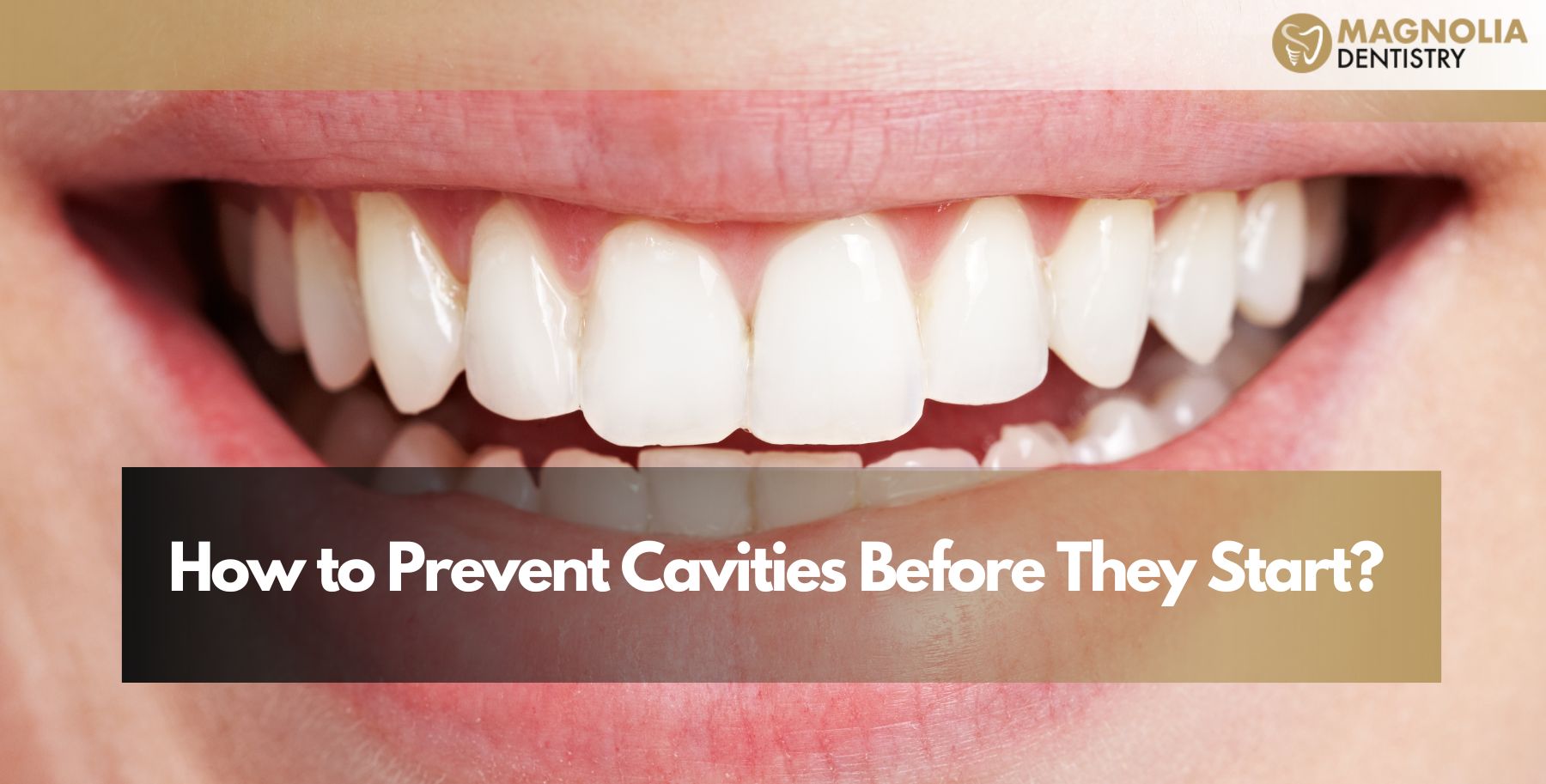 How to Prevent Cavities Before They Start | Magnolia Dentistry