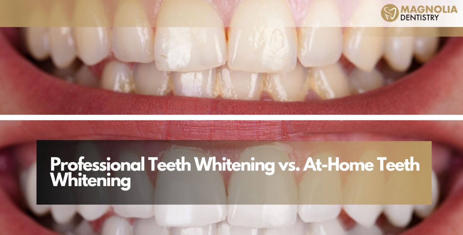 Professional Teeth Whitening vs. At-Home Teeth Whitening | Magnolia ...