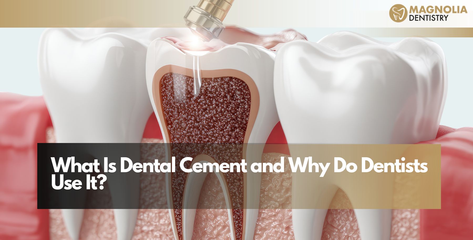 What Is Dental Cement and Why Do Dentists Use It | Magnolia Dentistry