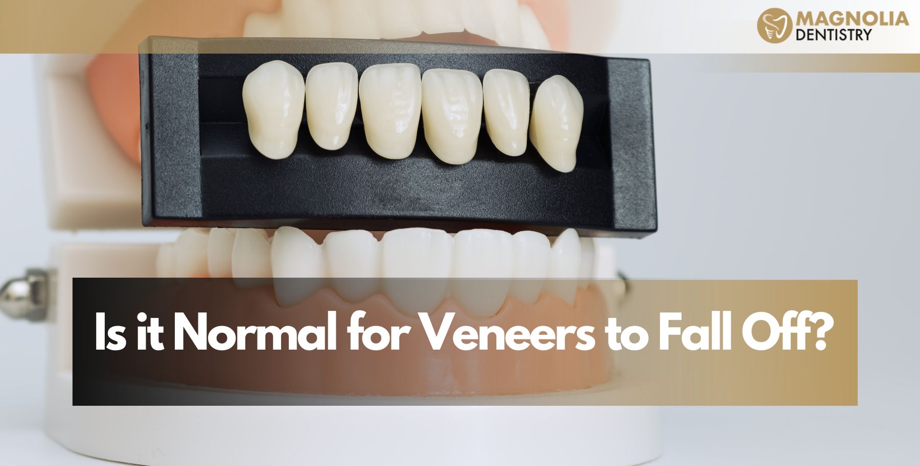 Is it Normal for Veneers to Fall Off | Magnolia Dentistry